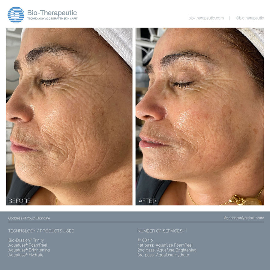 Bio-Brasion Trinity – Bio-Therapeutic