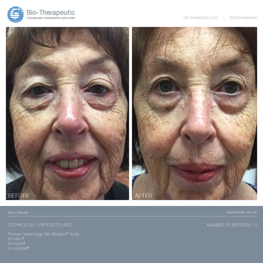 Bio-Brasion Trinity – Bio-Therapeutic