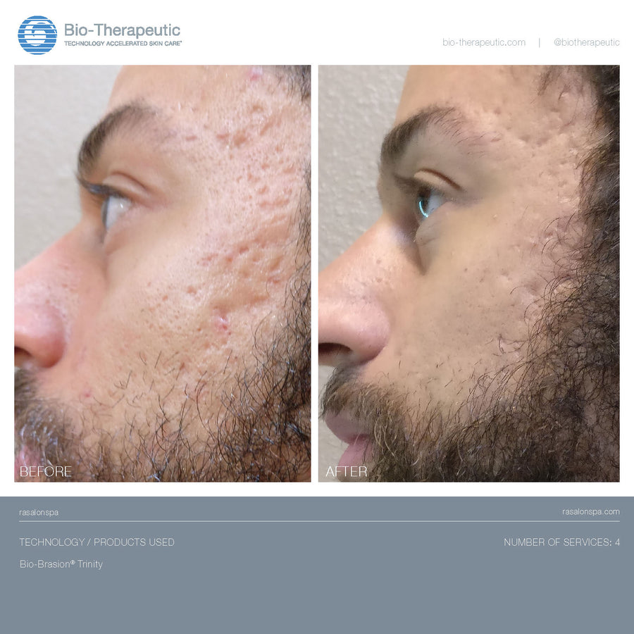 Bio-Brasion Trinity – Bio-Therapeutic