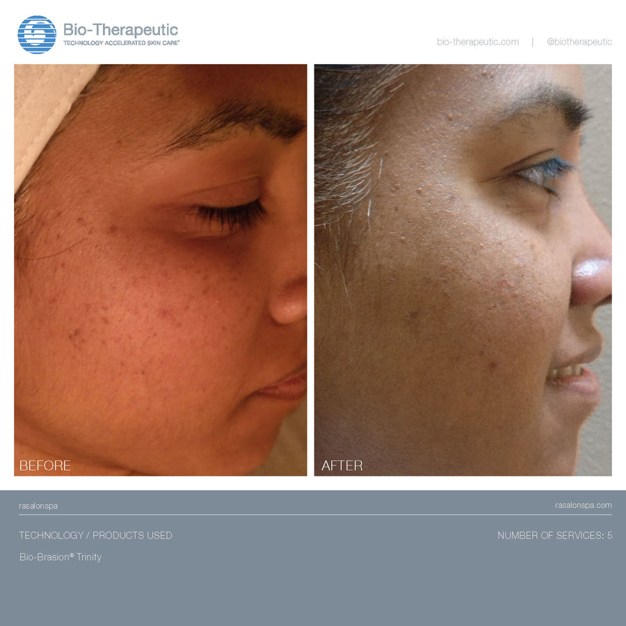 Bio-Brasion Trinity – Bio-Therapeutic