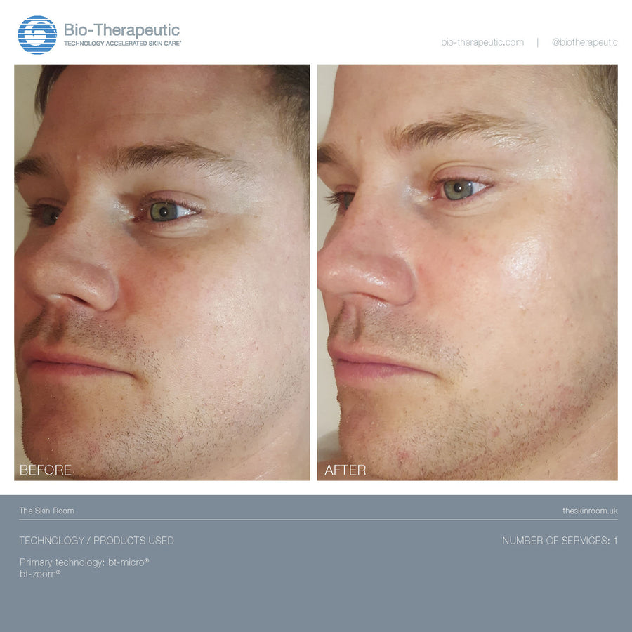 bt-micro + FREE Product – Bio-Therapeutic